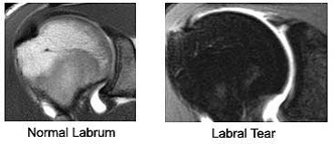 SLAP Tear Prevention | 321GOMD